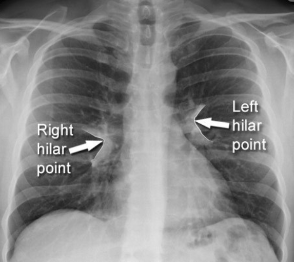 How To Read A Chest X-ray [Step-by-Step] - TheMDJourney