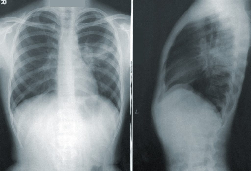 How To Read A Chest X-ray [Step-by-Step] - TheMDJourney